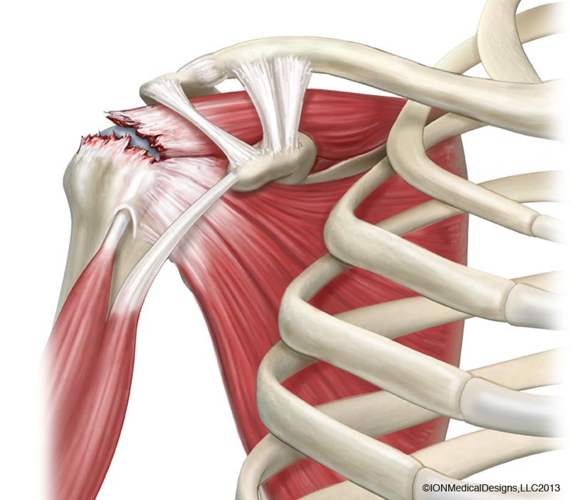 Rotator Cuff Tear Joint Preservation Center